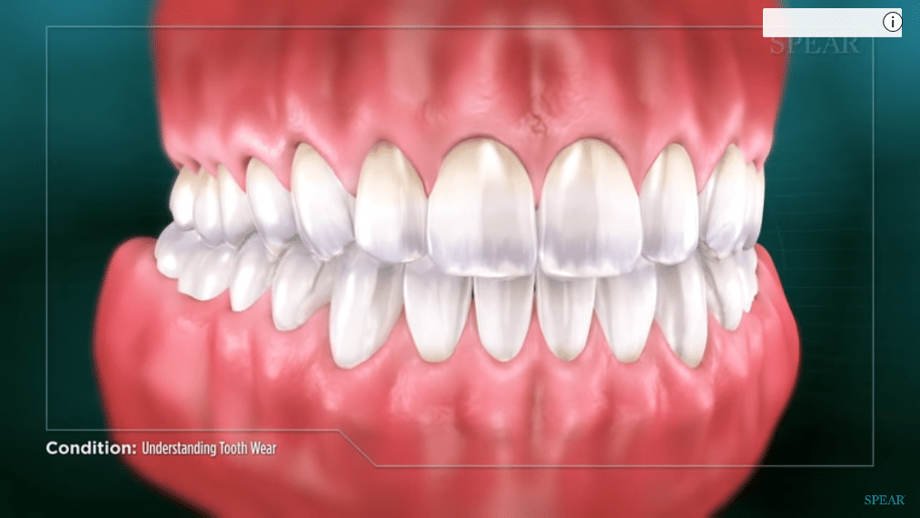 Understanding Tooth Wear Spears Education Video | Matonti Dental